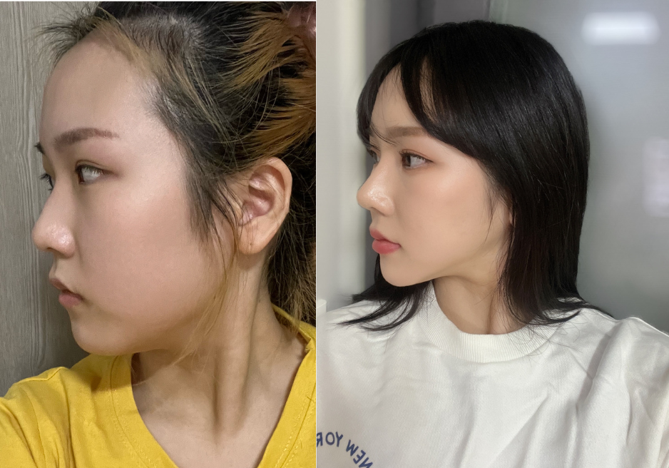 Square Jaw Reduction Surgery Costs in Korea: What You Need to Know | AB ...