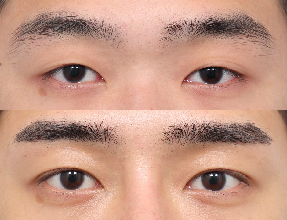Double eyelid surgery: In-Line, In-Outline, Semi-Outline, and Outline
