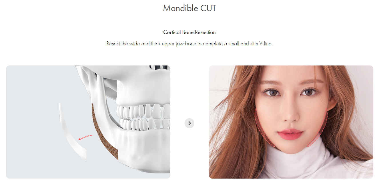 V-Line Surgery in Korea: Cost, Care, and Results | AB Plastic Surgery Korea